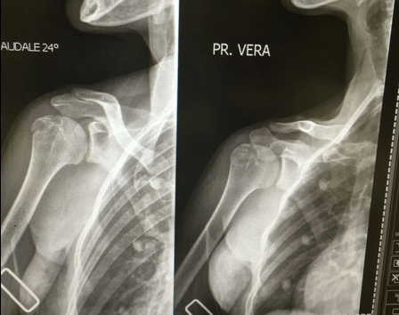 Il Sistema R.C.F nel recupero di una lussazione posteriore e frattura ...
